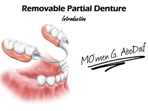 Removable Partial Denture 1 Introduction PDF