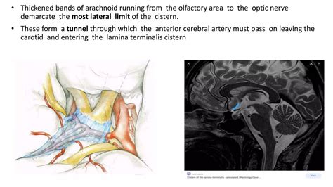 Anatomy Of Subarachnoid Cisterns Of Brain Pptx
