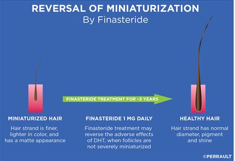 Finasteride And Dutasteride Gl Perrault Md Hair Loss And Hair Restoration