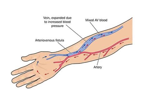 Hemodialysis Catheter Vs Av Fistula At Albert Jarman Blog
