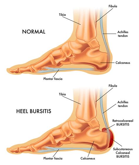 Bursitis Causes And Treatment My Footdr