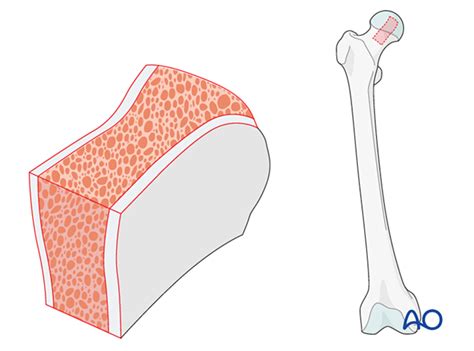 Bony Reconstruction With Augmentation In The Glenoid