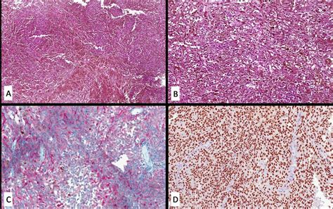 A Low Magnification Showing A Uniformly Hypercellular And Heavily Download Scientific Diagram