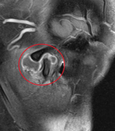 Tmj Synovial Osteochondromatosis Pacs
