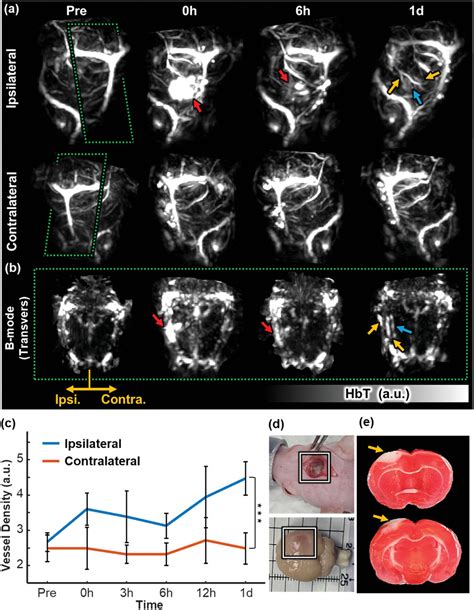 Non‐invasive Photoacoustic Cerebrovascular Monitoring Of Early‐stage