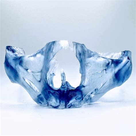 Upper Maxilla Model Only Zygomatic Treatment S3 Simple Smile Upper Maxilla Model Only Zygomatic Treatment S3 Simple Smile
