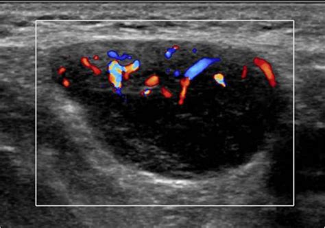 Color Doppler Sonogram Shows Peripheral Vascular Flow Within An Ovoid