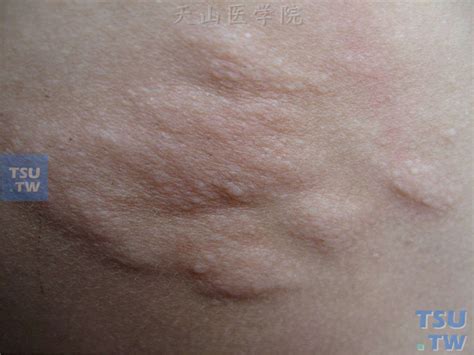 结缔组织痣connective tissue nevus症状表现 皮肤病学 天山医学院
