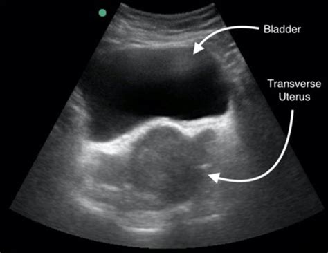 How To Perform And Interpret A First Trimester Transabdominal Point Of