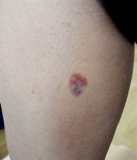 Signs Of Skin Cancer On Lower Leg At Kaitlyn Devine Blog