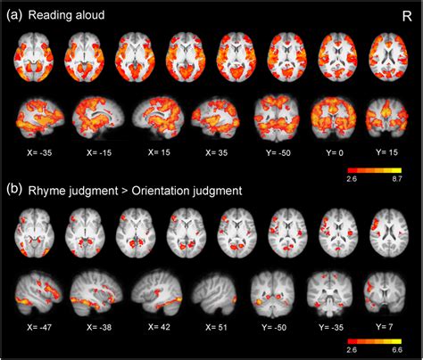 Brain Activations For Chinese Characters During The Reading Aloud Task Download Scientific