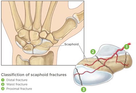 Scaphoid Fracture Causes Symptoms Diagnosis Treatment And Revovery Time