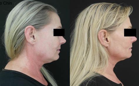 Once Or Twice A Week Optimizing Your Trt Injection Frequency