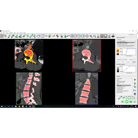 Medviso Segment 3d Print Laser Lines