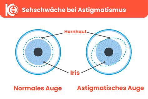 Astigmatismus Kudret Göz İstanbul