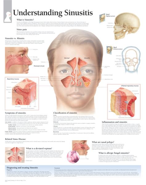 Chart Understanding Sinusitis