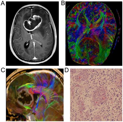 Mhj 1212 Introduction Diffusion Tensor Imaging Dti Is A Fairly New Magnetic Resonance Imaging
