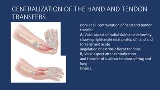 Upper Limb Congenital Anomalies Pptx