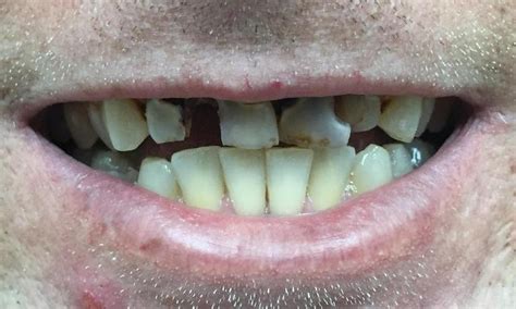 Root Canal Therapy In Wellington Before And After