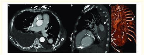 A C Chest Computerized Tomographic Angiography Showing A 34 Cm