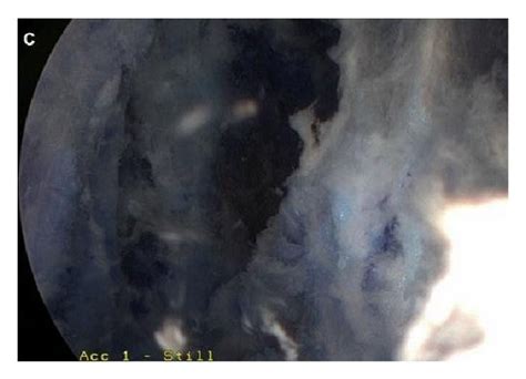 Arthroscopic Images A B And C Demonstrating Arthroscopic Download Scientific Diagram