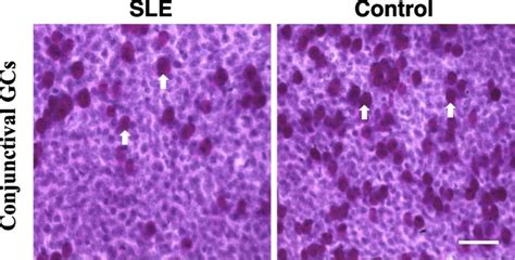 Evaluation Of Ocular Surface Inflammation And Systemic Conditions In Patients With Systemic
