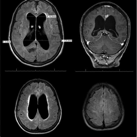 E Mri Scan Of A Patient With Normal Pressure Hydrocephalus Reprinted Download Scientific