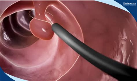 Polypectomy Surgery In India Procedure Cost And Top Hospitals