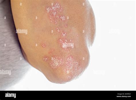 Psoriasis On Elbows Close Up Autoimmune Incurable Dermatological Skin Disease Psoriasis