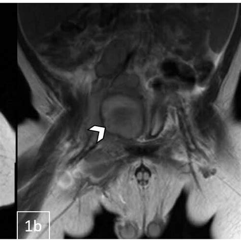 11 Month Old Male With A Palpable Reducible Mass In The Right Inguinal Download Scientific