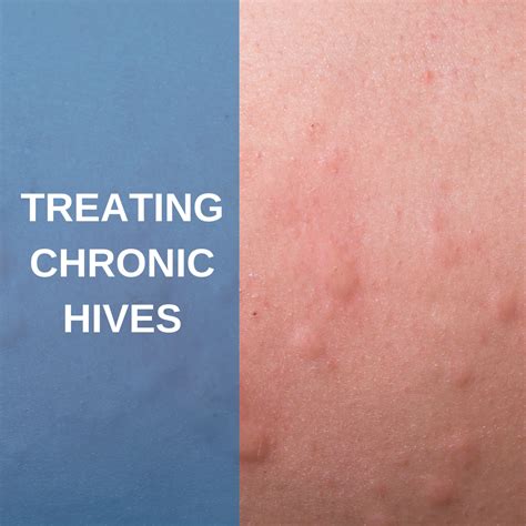 How To Treat Rash And Hives At Nell Velez Blog