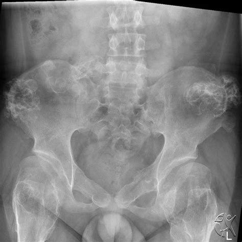 Chondrosarcoma Pelvis