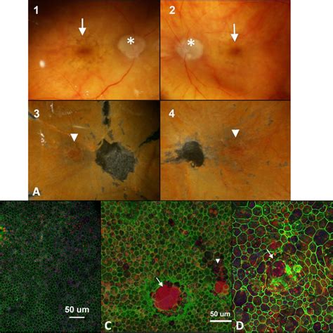 Retinal Pigment Epithelium Rpe Flatmount Preparation A Post Mortem