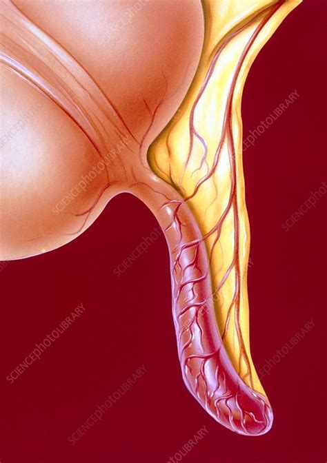 Illustration Of An Appendix With Appendicitis Stock Image M108 0268 Science Photo Library