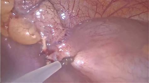 Lap Appendicectomy Youtube