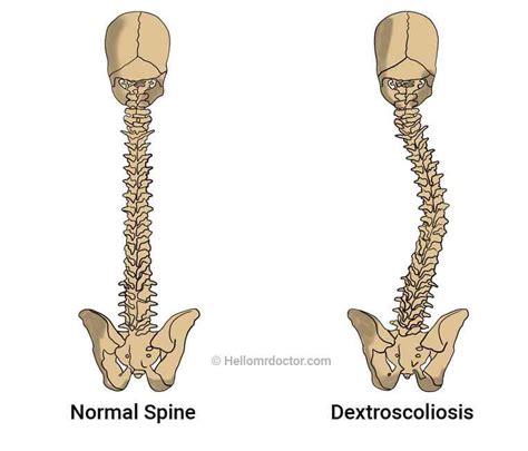 What Is Dextrocurvature Of Lumbar Spine At Isabel Cremean Blog
