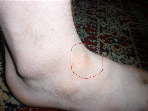 Сухое красноватое пятно на стопе Можно ли сказать что это по фото и по описанию