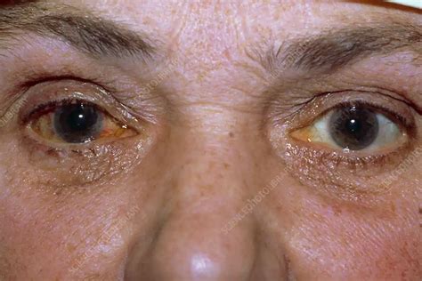 الجلوكوما الدموية