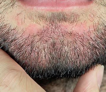 Reasons You May Be Growing A Patchy Beard How To Fix It