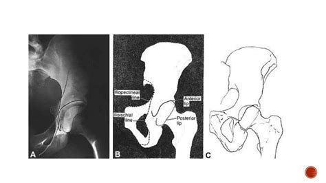 Surgical Approach To Acetabulum And Pelvis Pptx