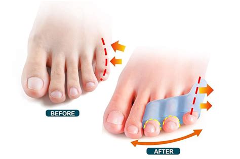 Common Toe Deformities Design Talk