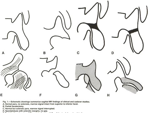 Figure 1 From Mr Imaging Of The Pars Interarticularis Semantic Scholar