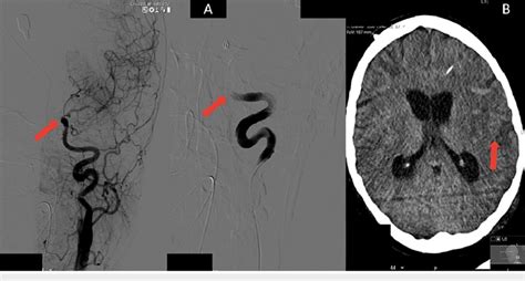 A Selective Catheterization Of The Ica Was Performed With A