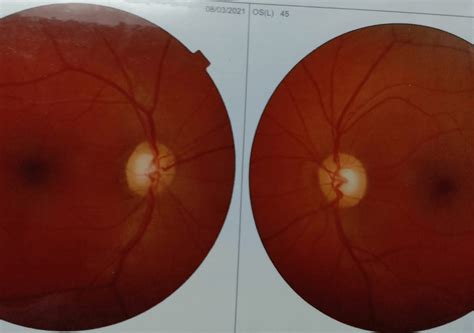 Am I Really A Glaucoma Suspect Or Is He Trying To Scare Me Rglaucoma