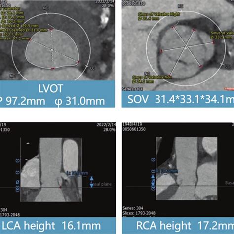 Preoperative Ct Evaluation Showing The Dilated Annulus Area 6132 Mm