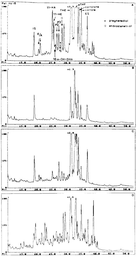 Patient 18 Female Had Severe Cushing Syndrome And Underwent Resection Download Scientific