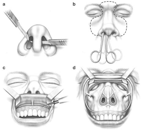 Midfacial Degloving Approach R Nsfl