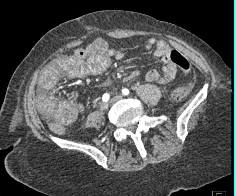 Small Bowel Enteritis Small Bowel Radiology Case Studies Ctisus Ct