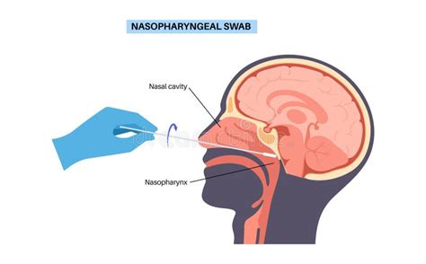 Nasopharyngeal Swab Procedure Stock Illustration Illustration Of Respiratory Detection 397946559