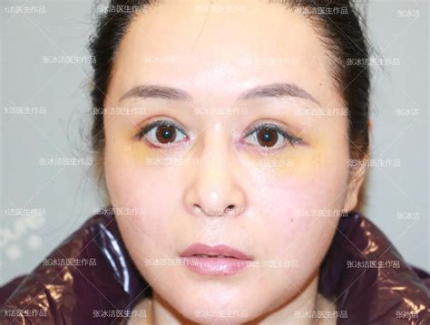 张冰洁双眼皮修复案例丨双眼皮窄变宽修复 内眼角疤痕修复 开外眼角综述 哔哩哔哩